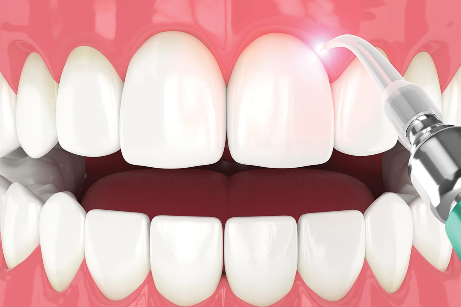 Laser Treatment - CXC Dental