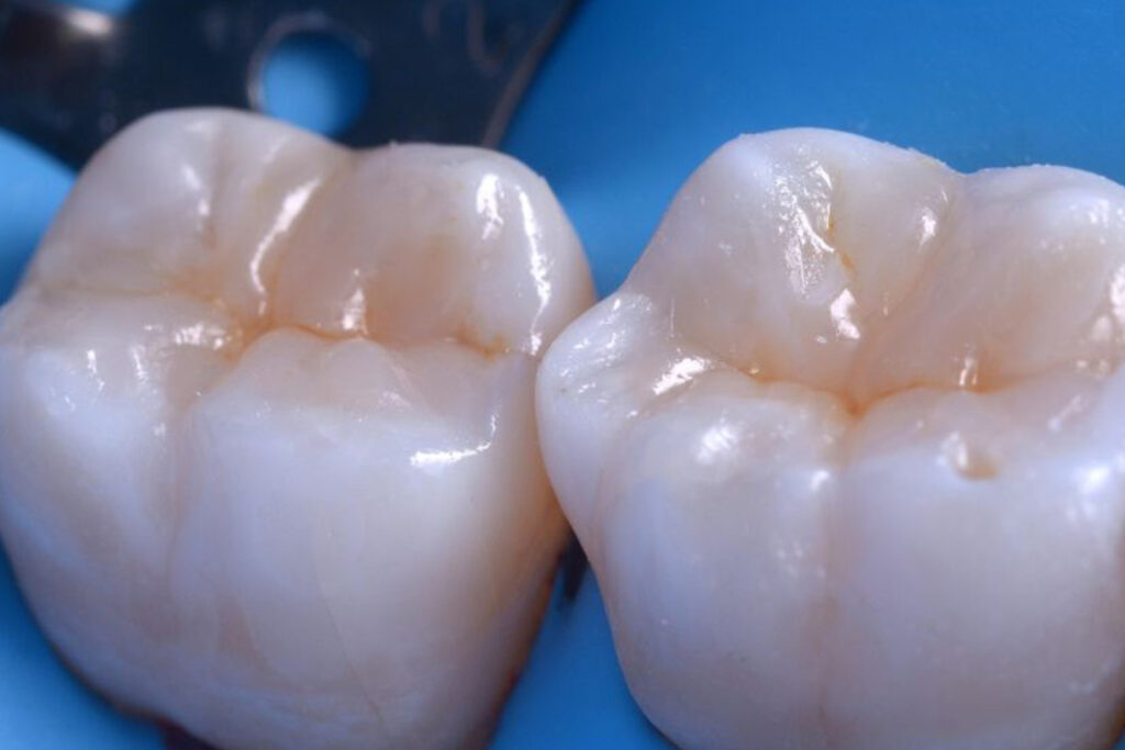 Pit and Fissure Sealants - CXC Dental