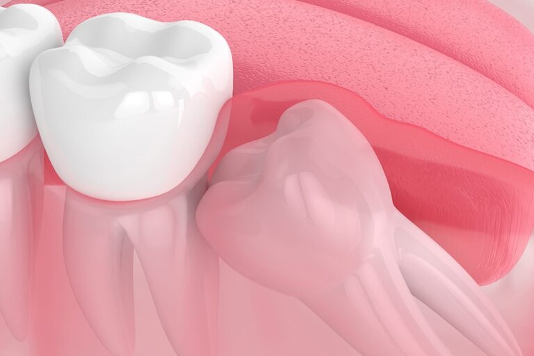 Wisdom Tooth Management - CXC Dental